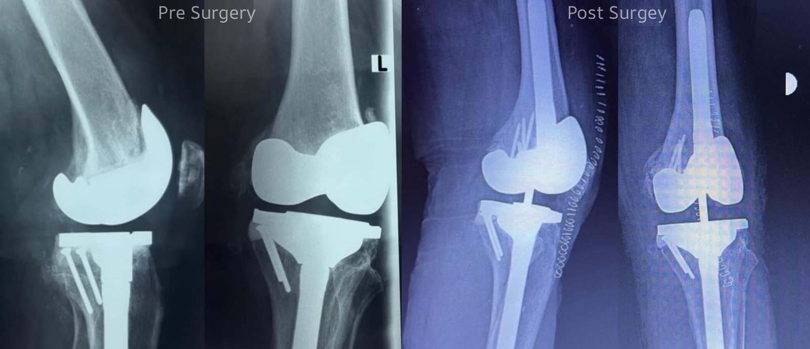 Advance Orthopaedics, Joint Replacement and Arthroscopy Centre | Dr. L ...